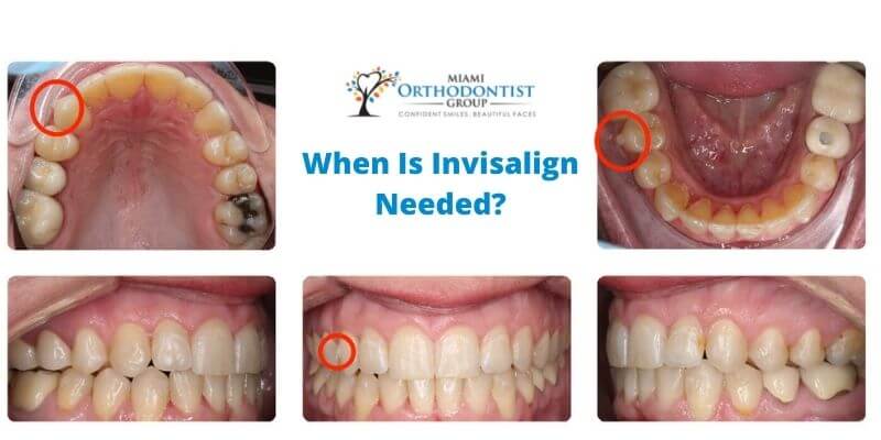 How Long Does Invisalign Take To Straighten Your Teeth Miami 