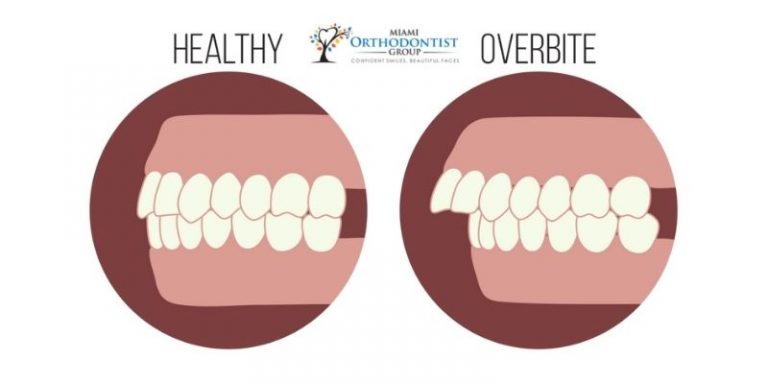 Types Of Bite Problems That Requires Braces - Miami Orthodontist Group Blog