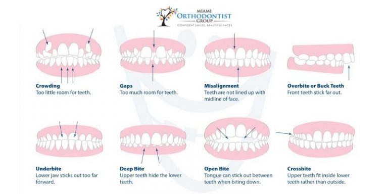 Types Of Bite Problems That Requires Braces - Miami Orthodontist Group Blog
