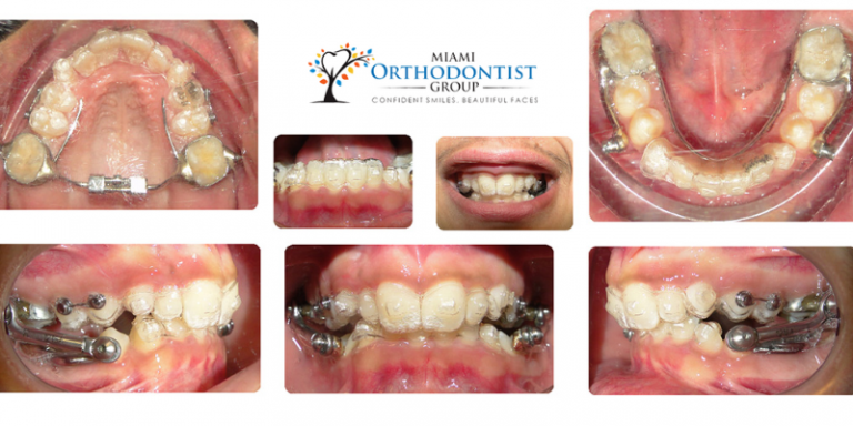 Guide On Various Dental Appliances - Miami Orthodontist Group Blog