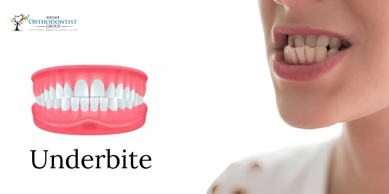 Miami Orthodontists Explain: Overbite, Underbite, and Crossbite ...